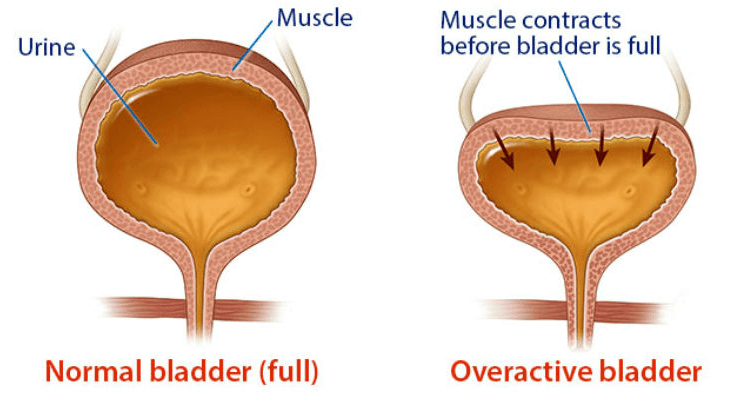 Overactive Bladder (OAB) – Pelvic Health Physical Therapy